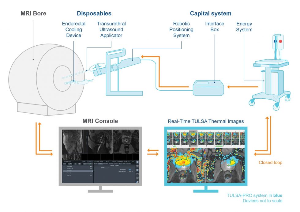 TULSA Procedure - Busch Center